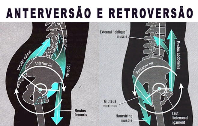 Quadril em anteversão ou retroversão, o que é e como resolver?